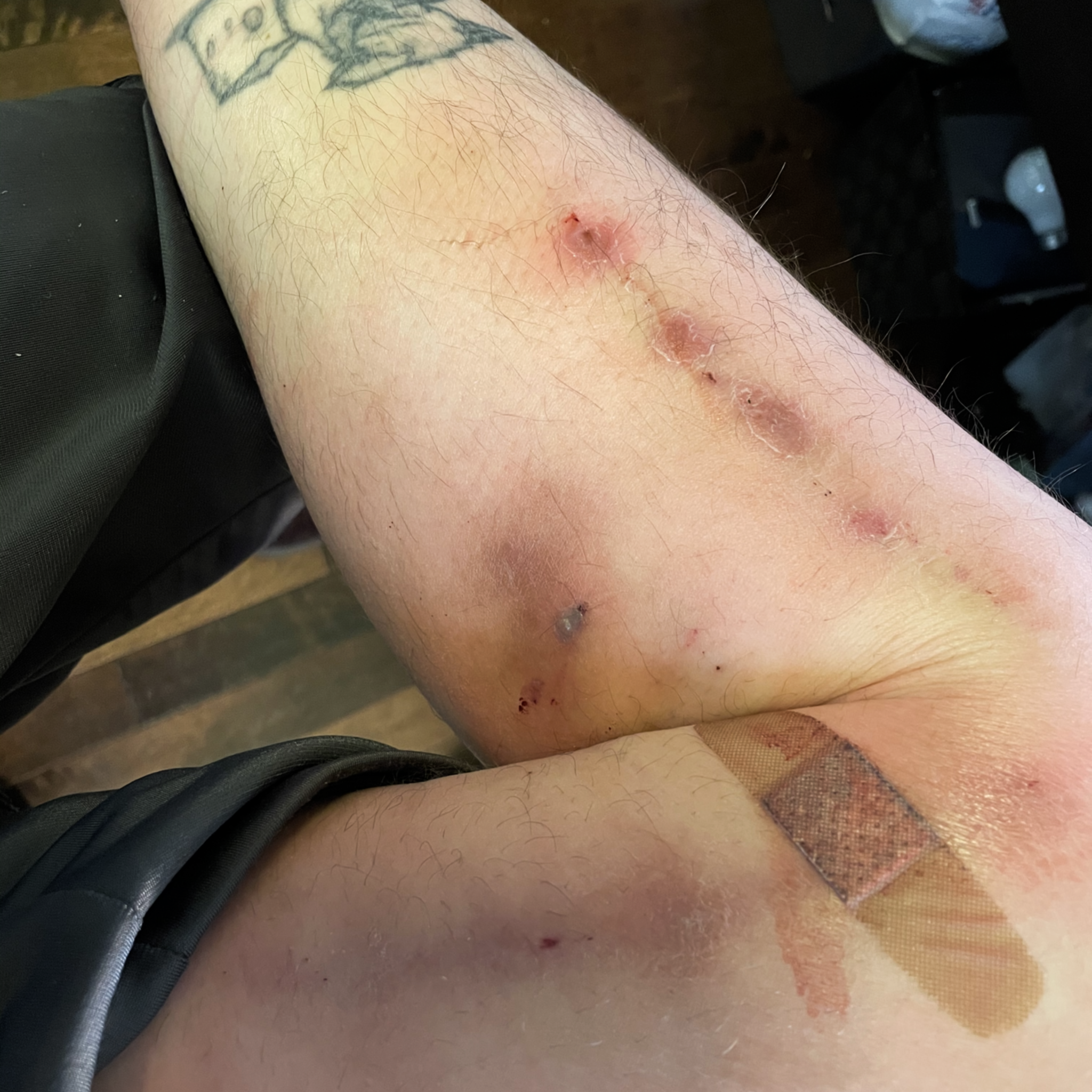 What I Learned From My First Injection Infection